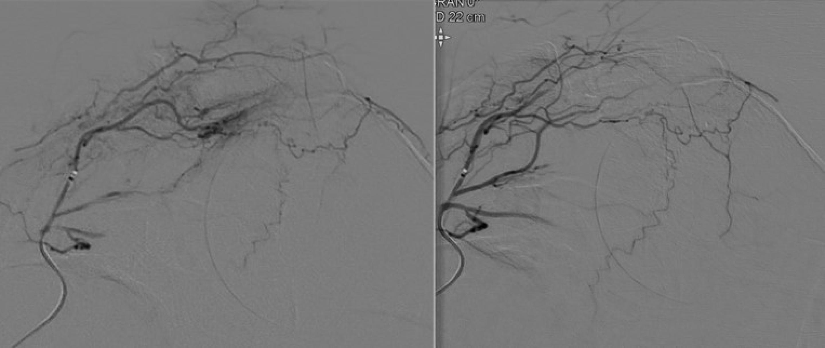 [CAS CLINIQUES] Traitement de la capsulite rétractile par embolisation ...